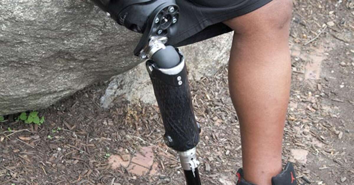 iFIT Transfemoral Prosthesis | Allard USA